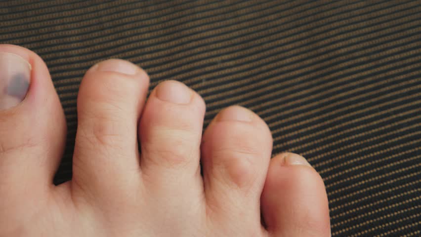 Sick Nail. Trauma to the Stock Footage Video (100% Royalty-free ...