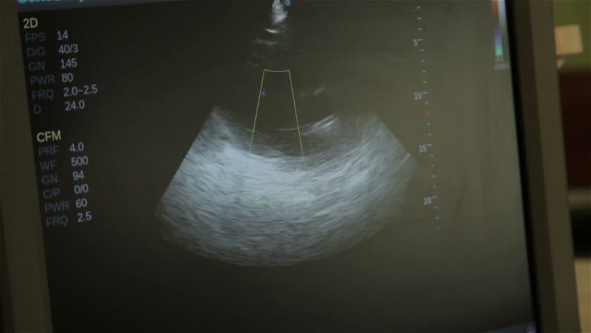Stock video of ultrasound. cardiology. monitor screen close up ...