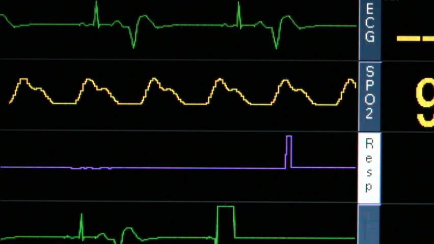Wavy Lines On Vital Signs Monitor, Close Up, Flatline As Patient Dies ...